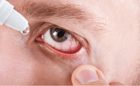 DryEye Rescue