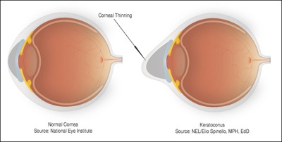 Healthy Corneas